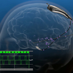 FDA Grants Premarket Approval (PMA) for the NeuroPace® RNS® System to ...