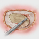 Cook® Medical Introduces Biodesign® Duraplasty Graft to ...