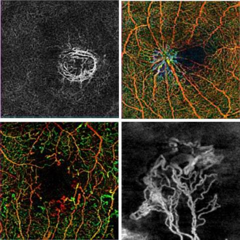 ZEISS Presents Its New Generation of Vascular Imaging: OCT Angiography ...