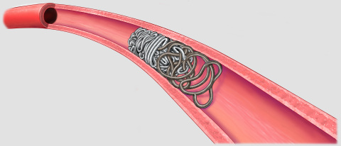Penumbra Introduces POD® Packing Coil for the Embolization of ...
