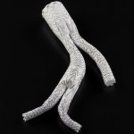GORE® EXCLUDER® Iliac Branch Endoprosthesis Approved in Japan