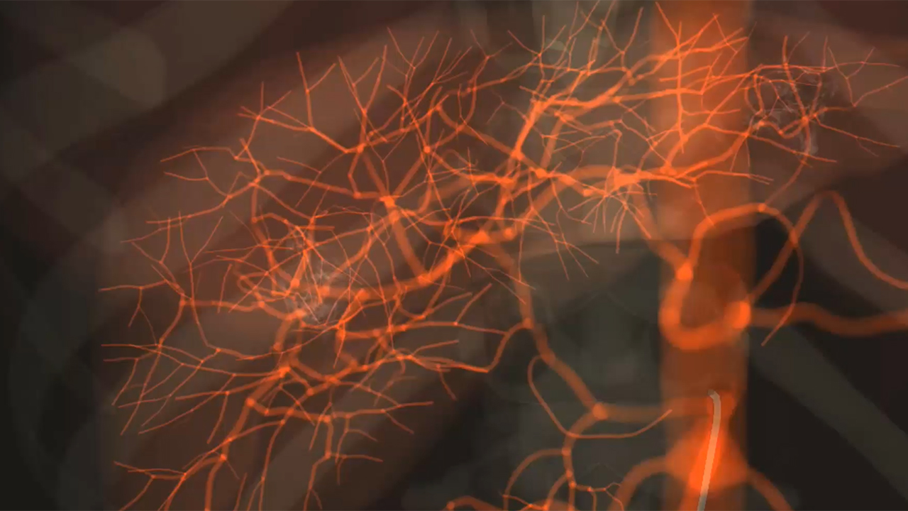 Mentice Aims to Reduce TACE Procedure Times, Minimize Radiation with ...