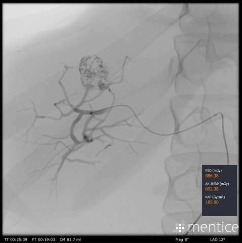 Mentice Aims to Reduce TACE Procedure Times, Minimize Radiation with ...