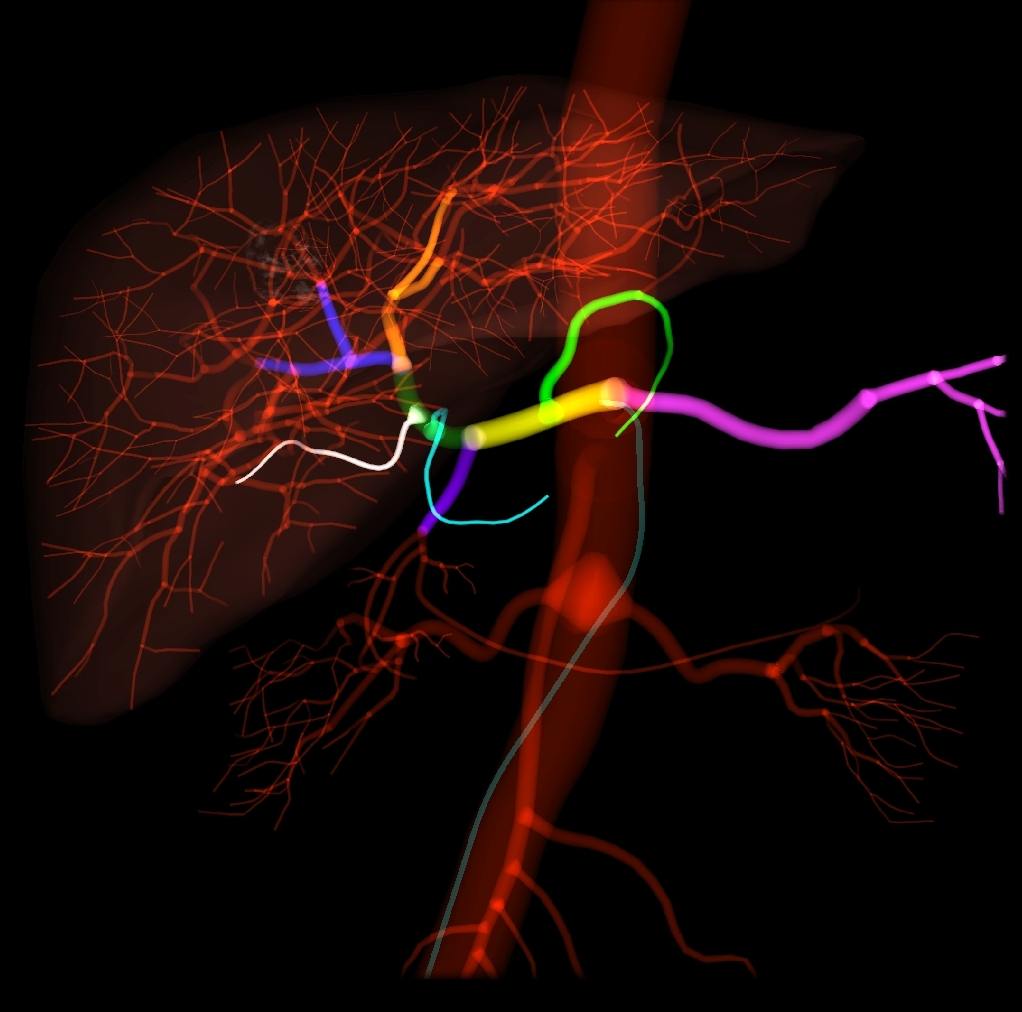 Mentice Aims to Reduce TACE Procedure Times, Minimize Radiation with ...