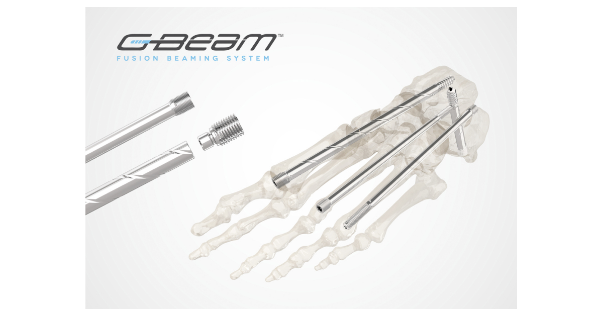 Orthofix Receives FDA 510(k) Clearance of G-Beam Fusion Beaming System ...