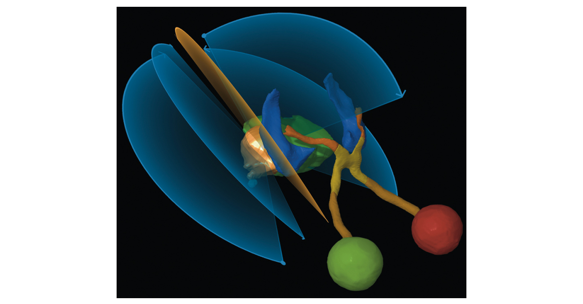 Brainlab Introduces New Hi-Res Planning Algorithm for VersaHD ...