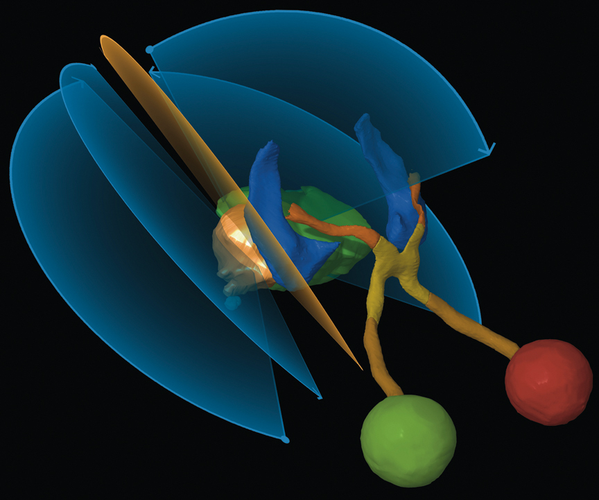 Brainlab Introduces New Hi-Res Planning Algorithm for VersaHD ...