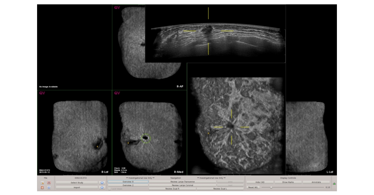 Concurrent-Read AI System From QView Medical Reduces ABUS Exam ...