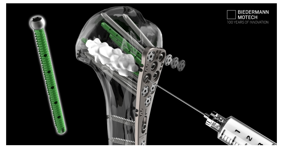 Biedermann Motech to Launch MDS Injection Screw for its Polyaxial ...