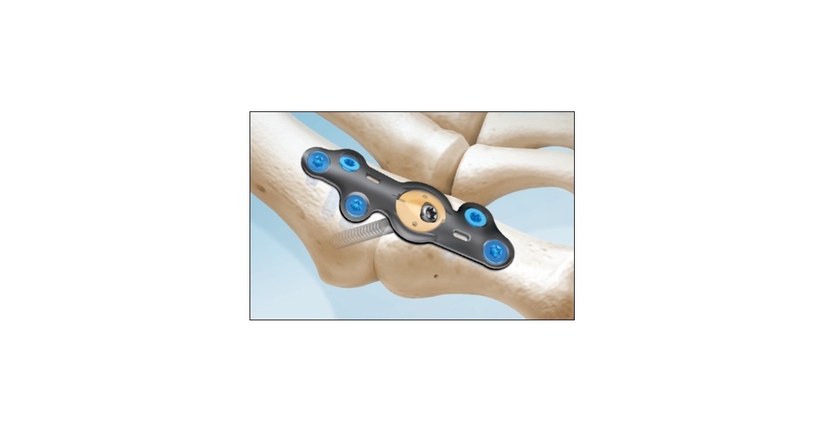 In2Bones Commercializes CoLink® View “See-Through” Plating System ...