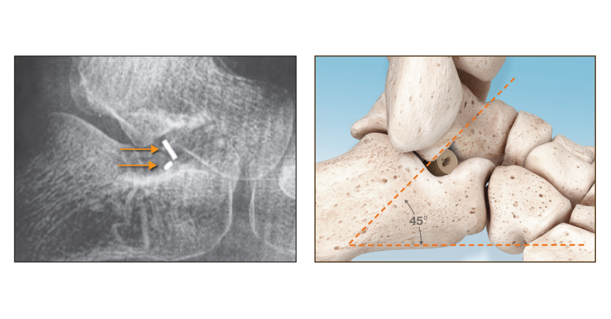 In2Bones Expands Its Lead in PEEK Lower Extremity Implants with the ...