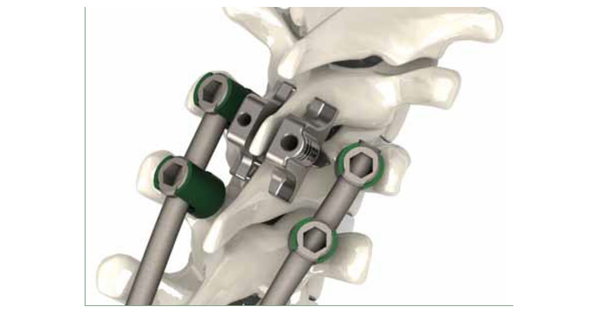 Southern Spine Announces New Thoracic Dual Lamina Implants for ...