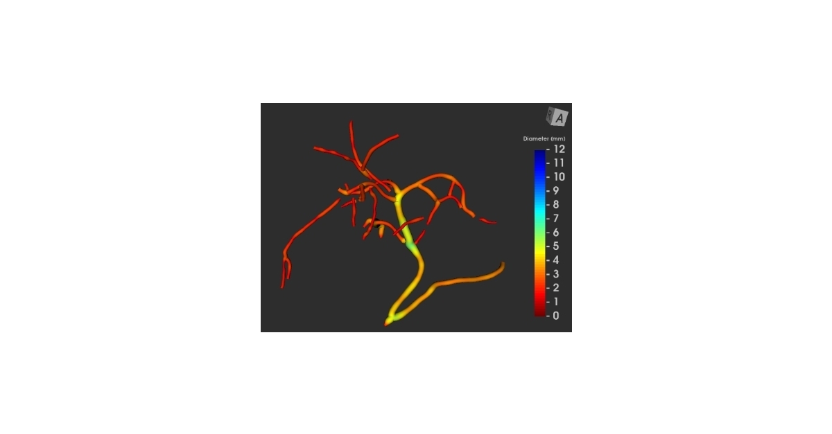 Perspectum Diagnostics: New Quantitative Biliary Imaging Technology ...
