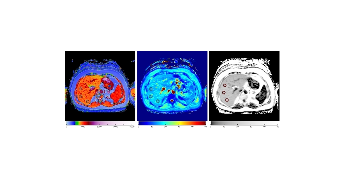 Reliable, Repeatable, Reproducible: Perspectum Diagnostics Demonstrates ...
