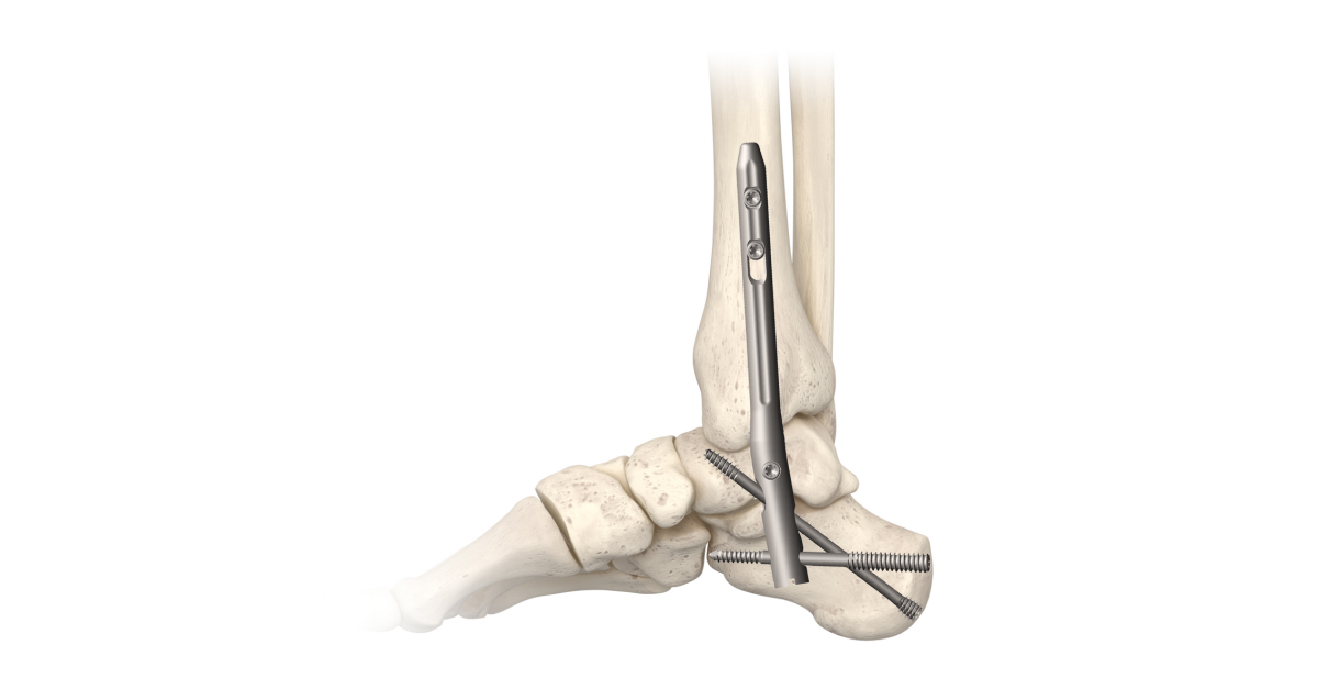In2Bones Announces the Global Launch of the TriWay® TibioTaloCalcaneal ...