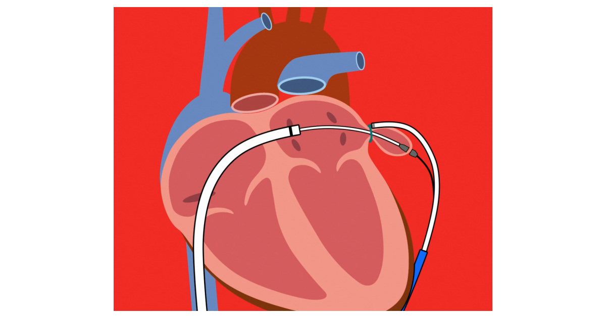 SentreHEART Receives CE Mark for LARIAT-RS™ 50mm and Expanded ...