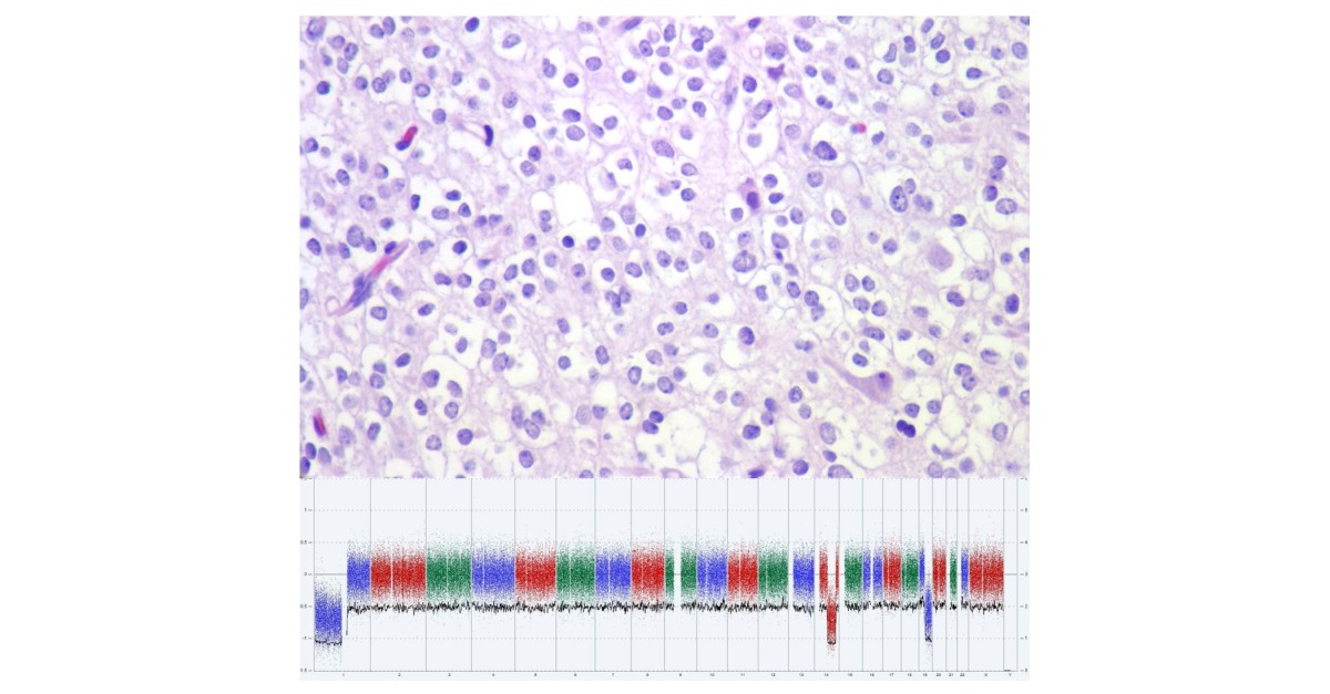 CAP Opens Comment Period on Diffuse Glioma Guideline; Participate to ...