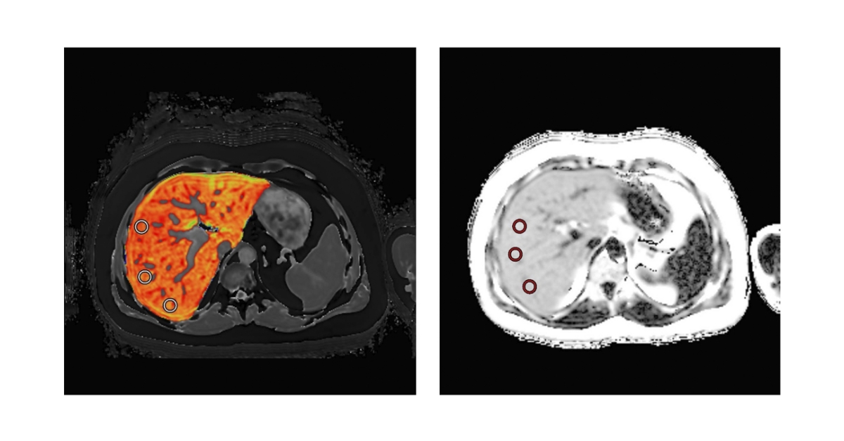 Perspectum Announces FDA Grant Award for LiverMultiScan to Help NASH ...