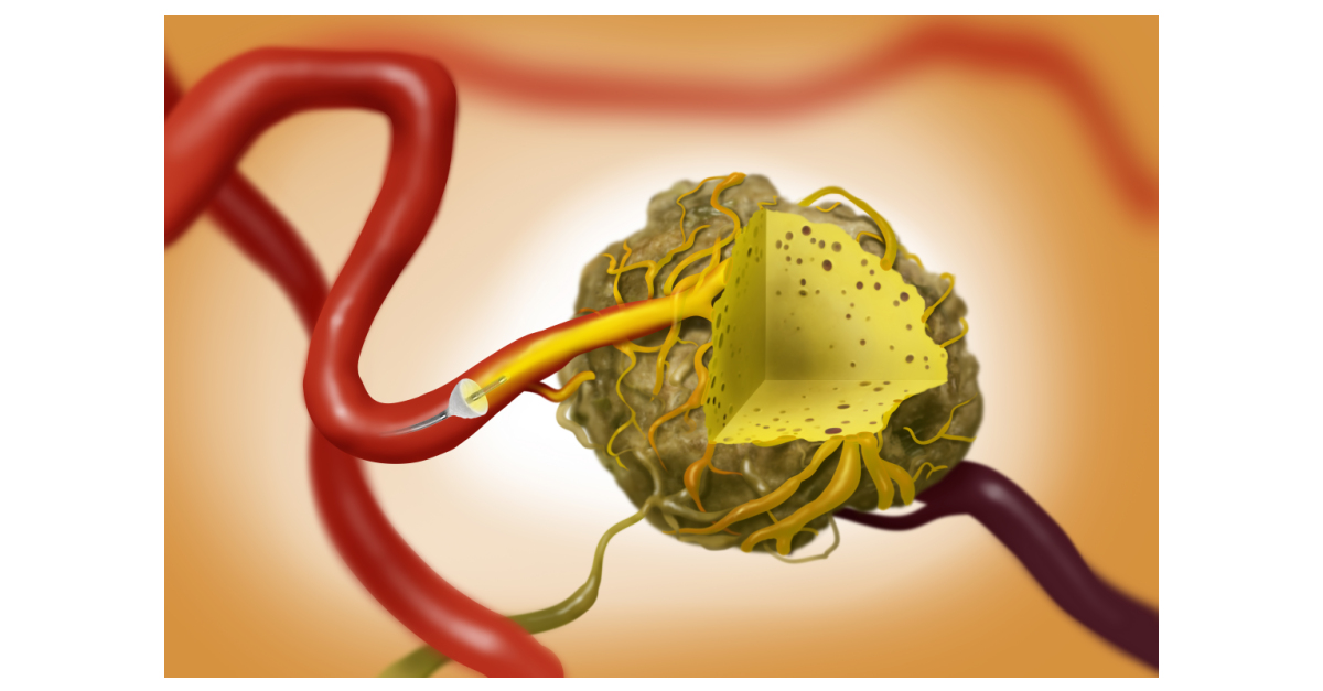 TriSalus™ Life Sciences Launches the new TriNav™ Infusion System, an ...