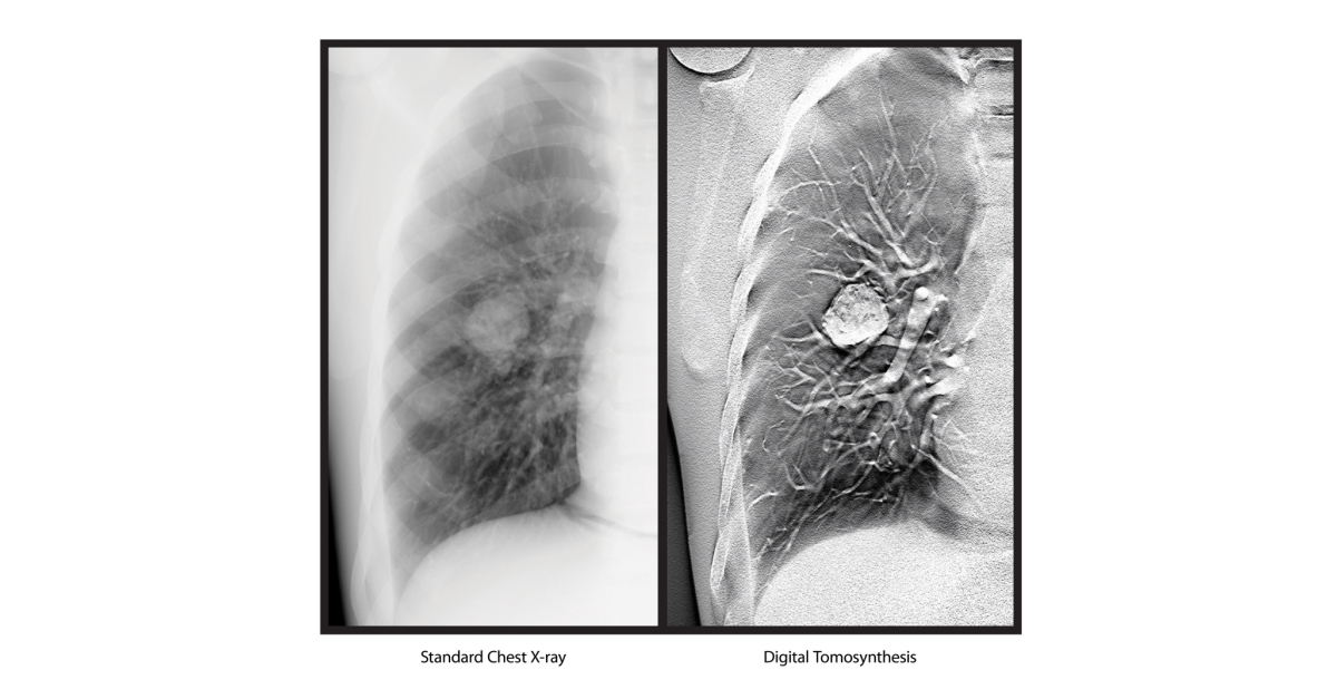 Carestream Digital Tomosynthesis Receives FDA Clearance | Business Wire