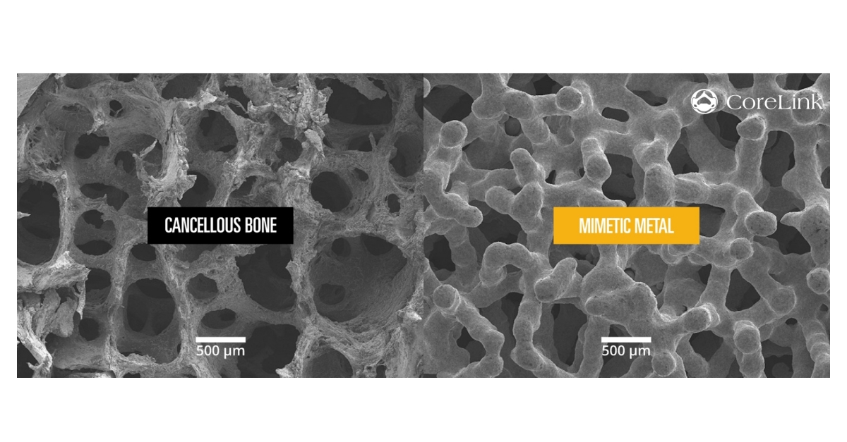 CoreLink Surpasses 5,000 Implants With Proprietary 3D Printed ...