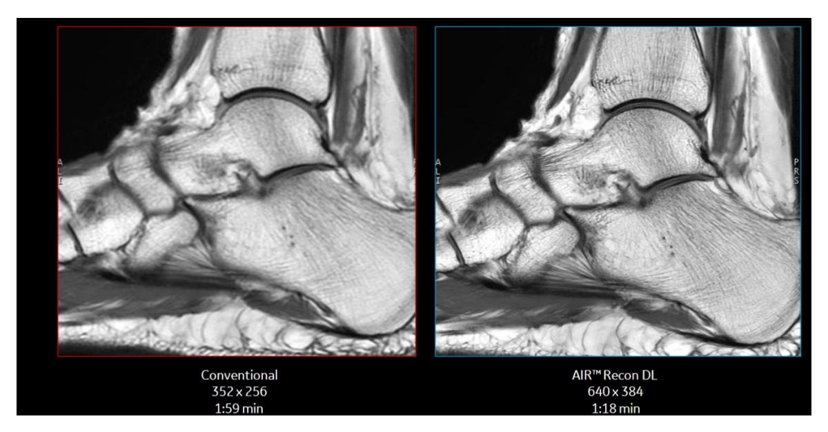 Shorter Scans and Better Image Quality: Deep Learning-Based MR Image ...