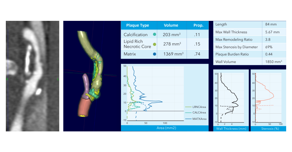 Study Demonstrates that AI Technology is Better Predictor of Stroke ...