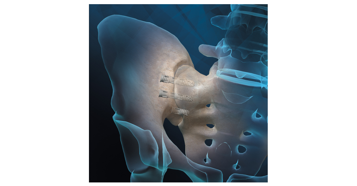 Orthofix FIREBIRD SI Fusion System Receives Additional FDA Clearance ...