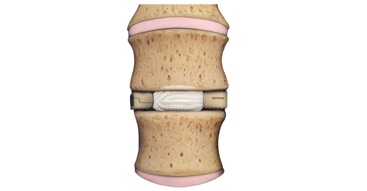 Spineology Completes Enrollment in Post-Market Study of Novel ...