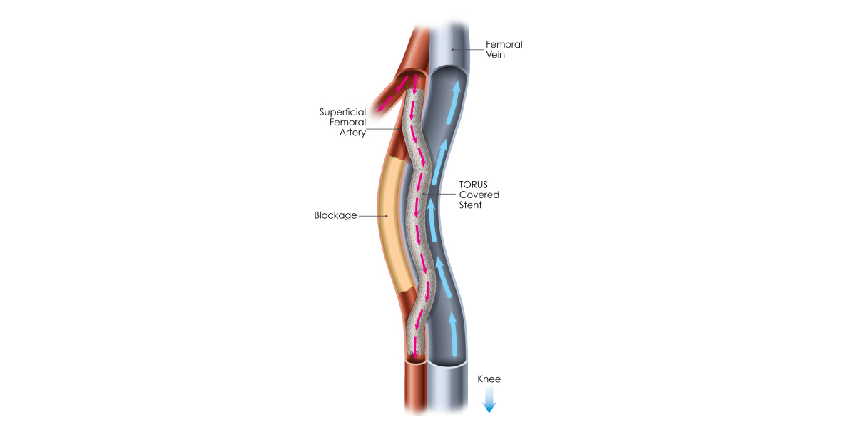 PQ Bypass Completes Enrollment in DETOUR2 Percutaneous Femoral ...