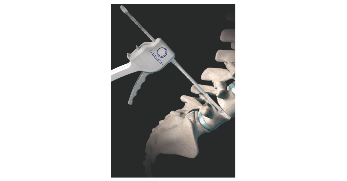 Orthofix Launches O-GENESIS Graft Delivery System and New Hydrated ...