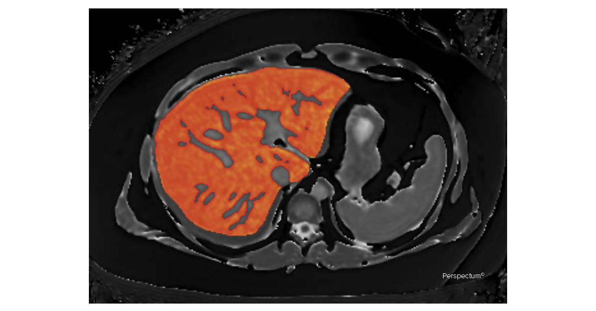 Perspectum Present Evidence of Cost-Effectiveness of LiverMultiScan ...