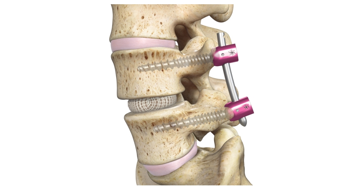One-Year Outcomes Data from the OptiMesh® SCOUT (Spineology® Clinical ...