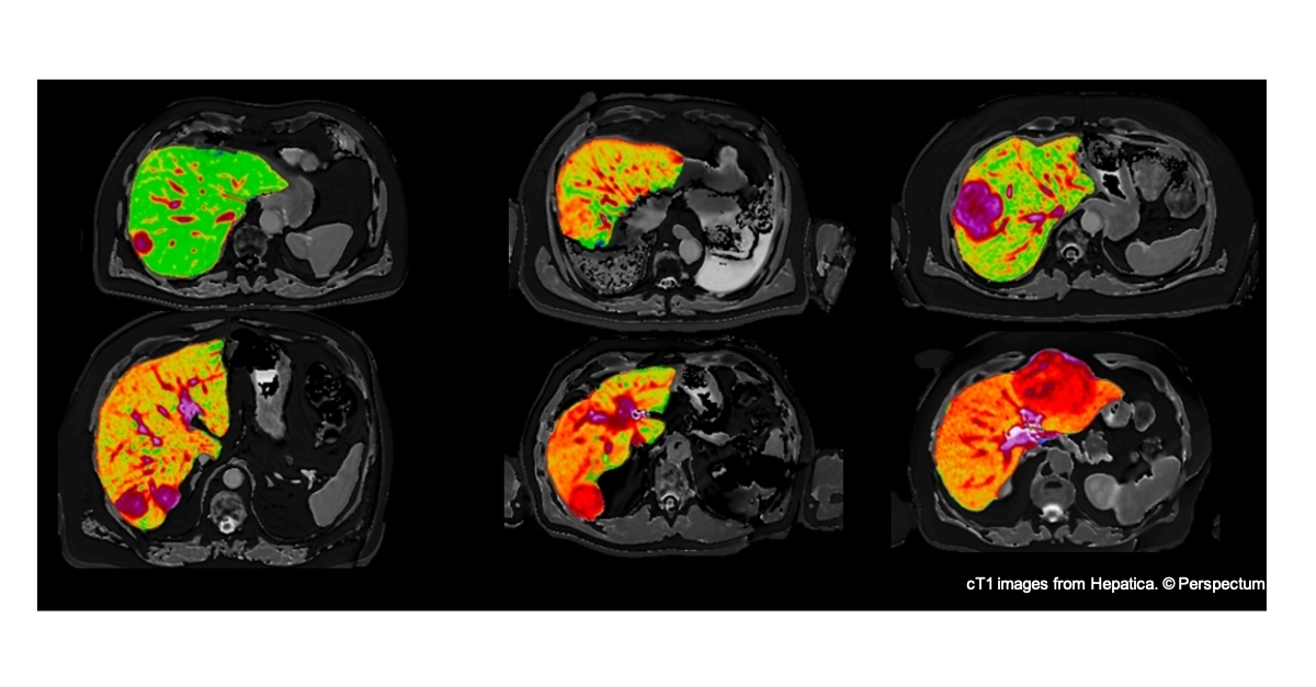 FDA Clearance for Hepatica, Perspectum’s Surgical Decision Support Tool ...
