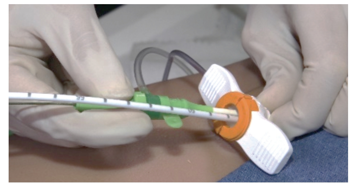 MEDCERT Enables the Use of the Single Access Procedure with Impella CP ...