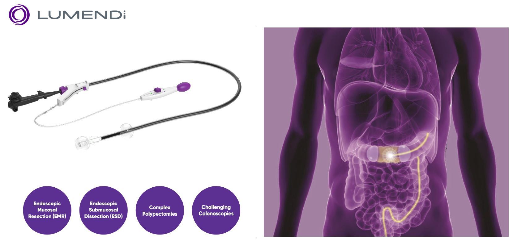 Lumendi Introduces EZ Glide Hydrophilic Coating for Its DiLumen ...