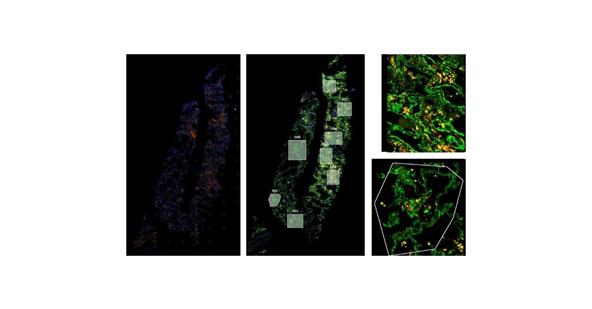 NanoString’s Digital Spatial Profiling Platform Used to Create ...