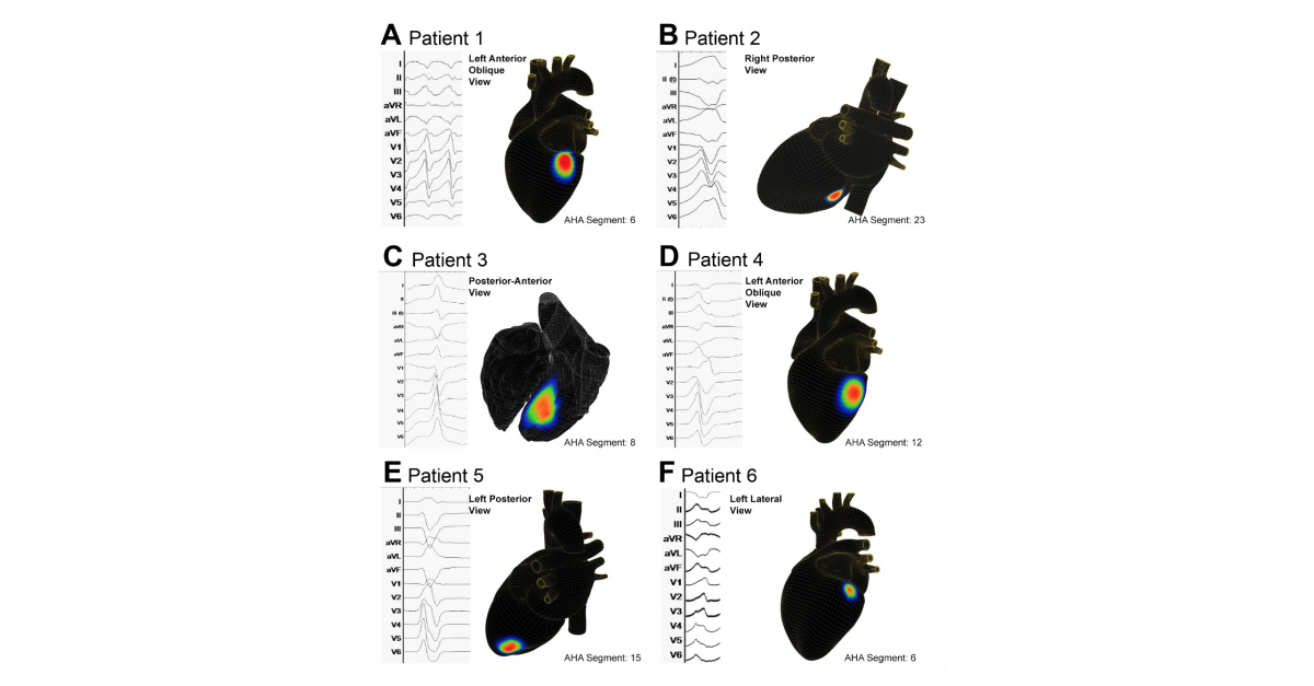 vMap™’s Role in Optimizing Non-Invasive Radio-Ablation Therapy ...
