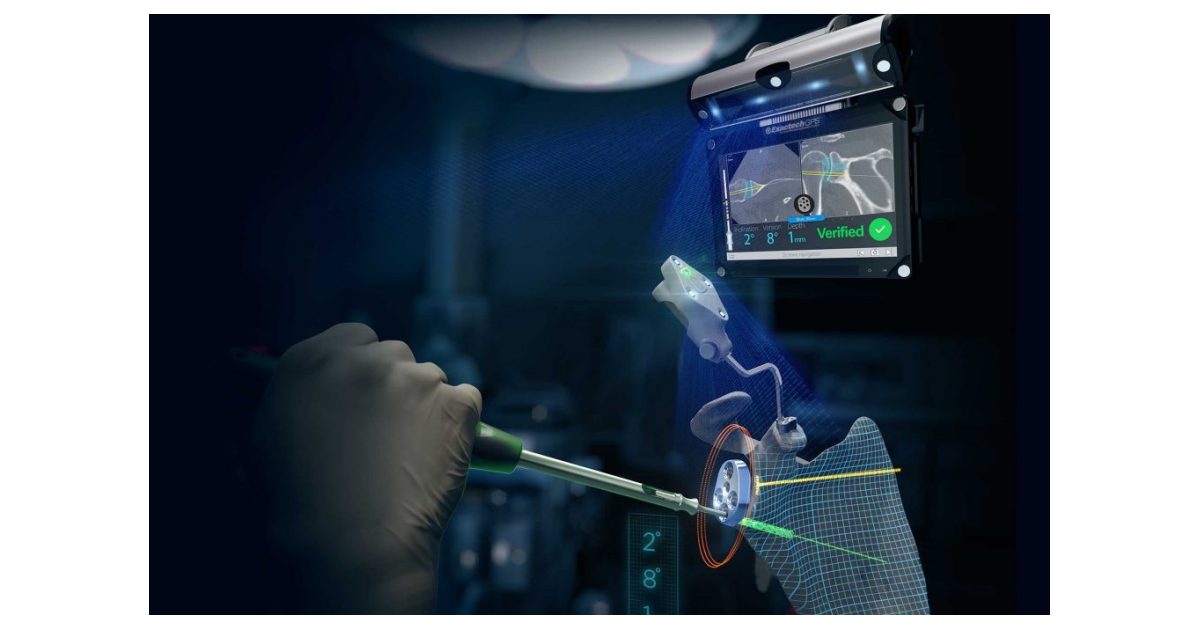 Exactech Enhances ExactechGPS® Shoulder Replacement Navigation Software ...