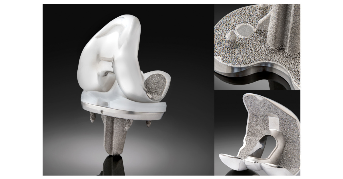 Exactech Announces Full Launch of its Truliant® Porous Knee System ...