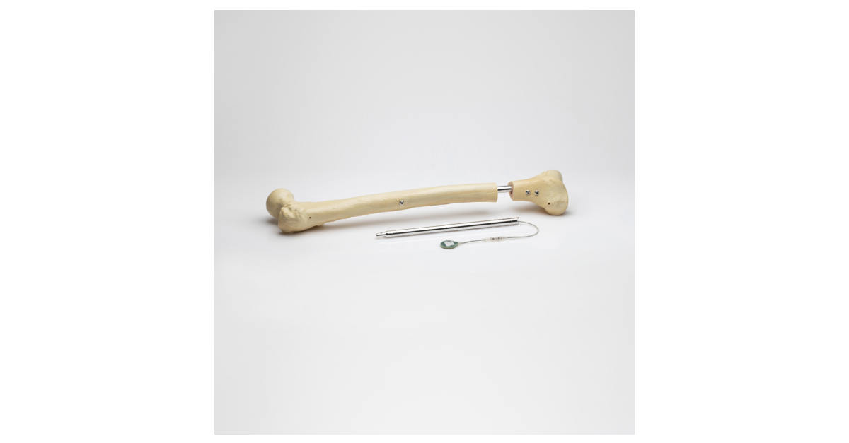 Orthofix Announces First US Pediatric Implant of the Fitbone Limb ...