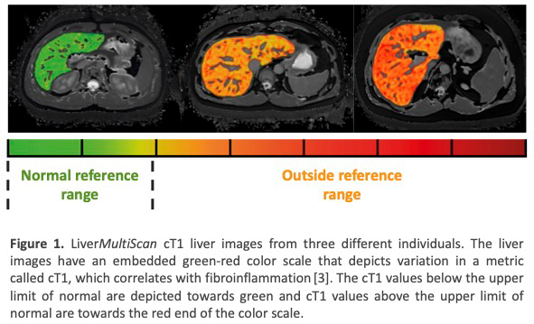 New study finds Perspectum’s LiverMultiScan may positively impact ...