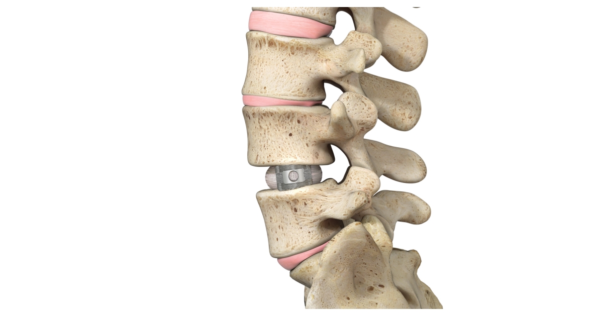 Spineology Launches First-of-Its-Kind Duo Ti™ Expandable Interbody ...