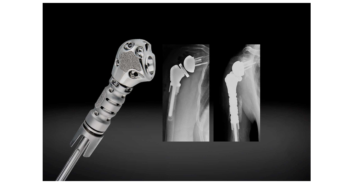 Exactech Announces Launch of Humeral Reconstruction Prosthesis in ...