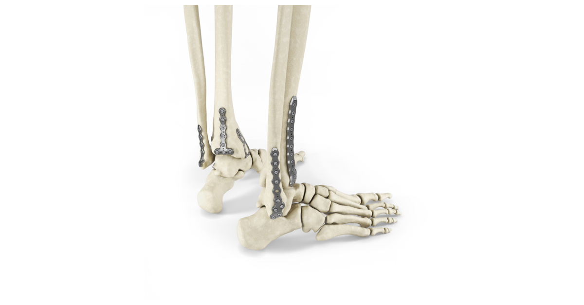 Enovis™, Formerly Branded DJO®, Introduces Arsenal Ankle Plating System ...