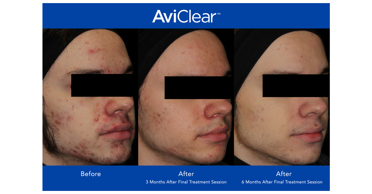 Cutera Announces Over 1,000 AviClear™ Acne Treatments Performed ...