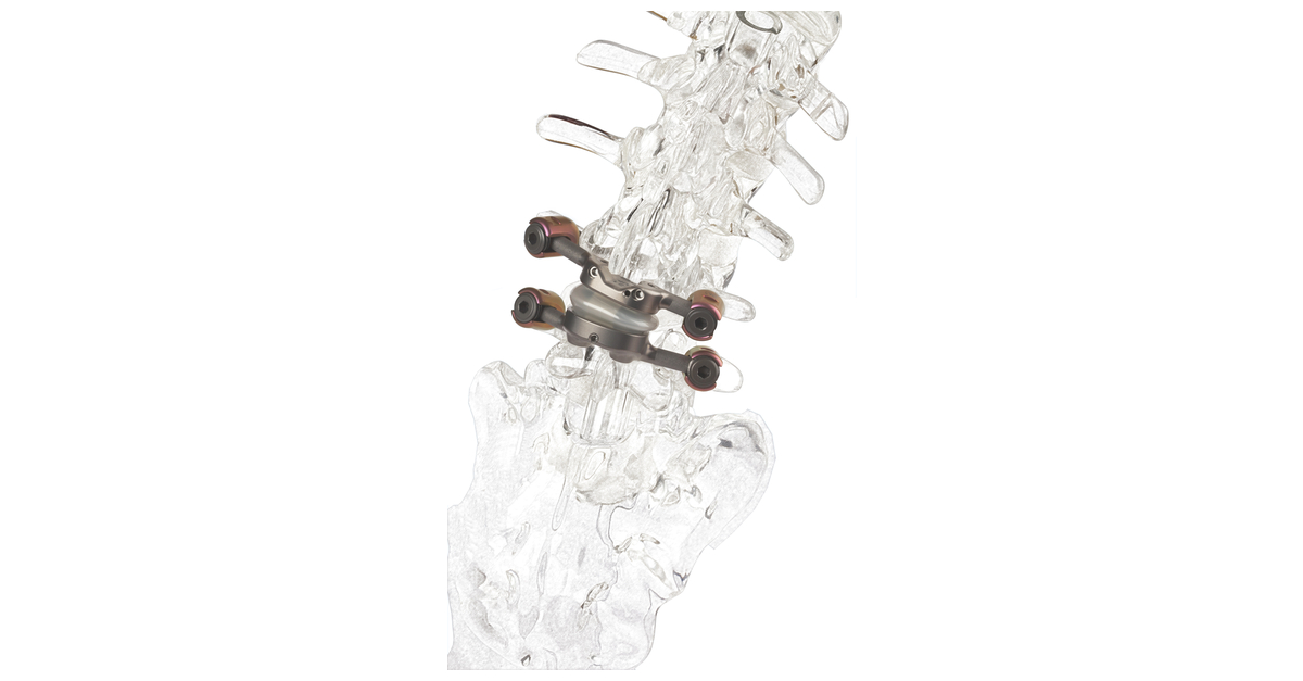 Premia Spine’s TOPS™ Facet Replacement Demonstrates Significant ...