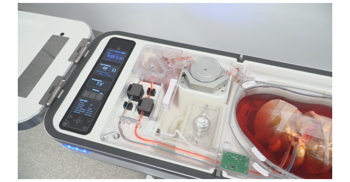 Organ Recovery Systems’ LifePort® Liver Transporter Preserves First ...