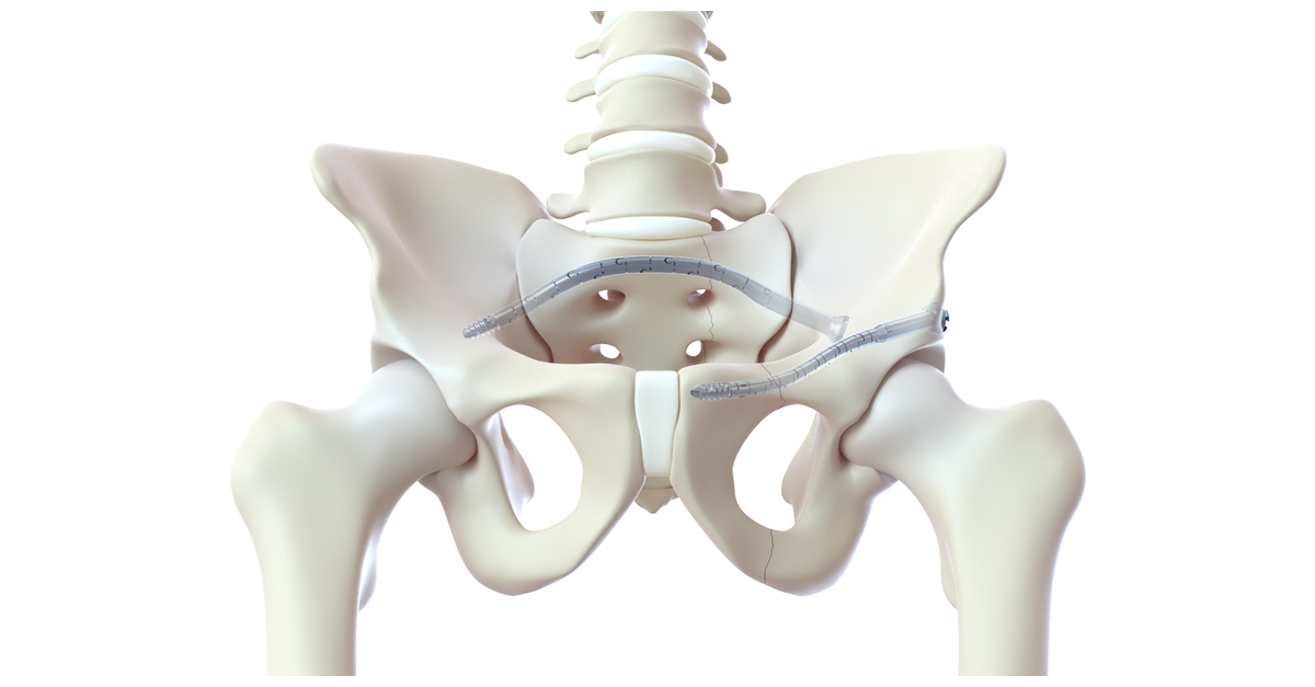 CurvaFix Launches Smaller-diameter CurvaFix® IM Implant | Business Wire