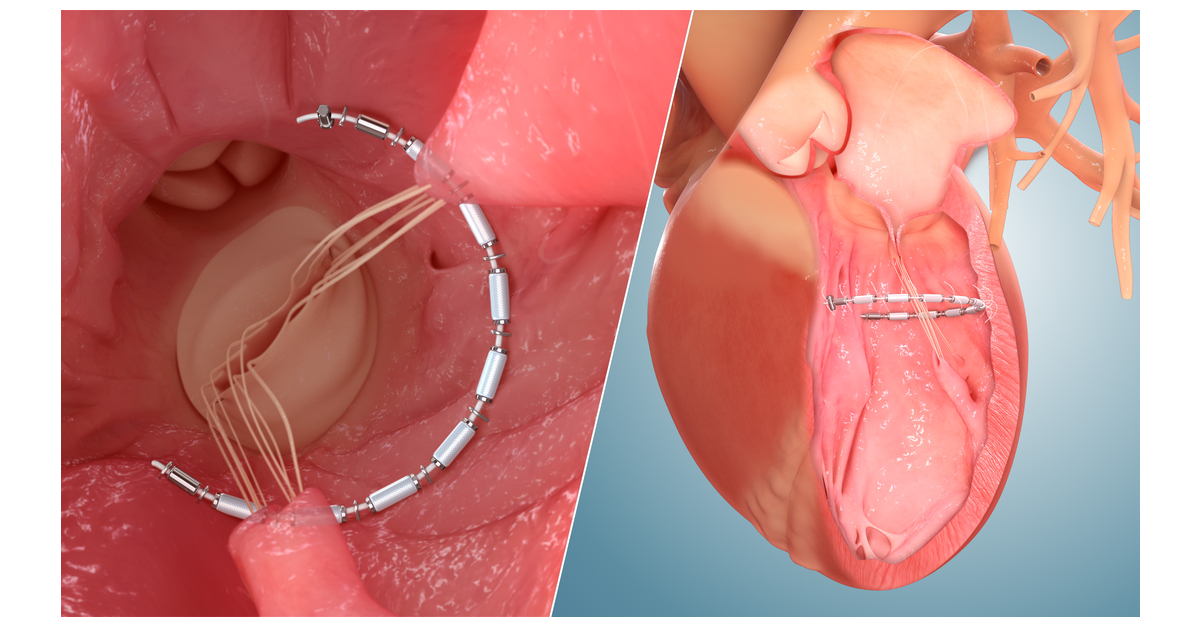 Ancora Heart Inc. and egnite, Inc. Announce Strategic Partnership to ...